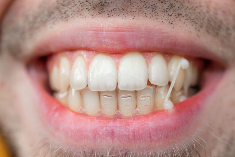 Invisible Adjustments: Does Removing Invisalign Attachments Hurt?